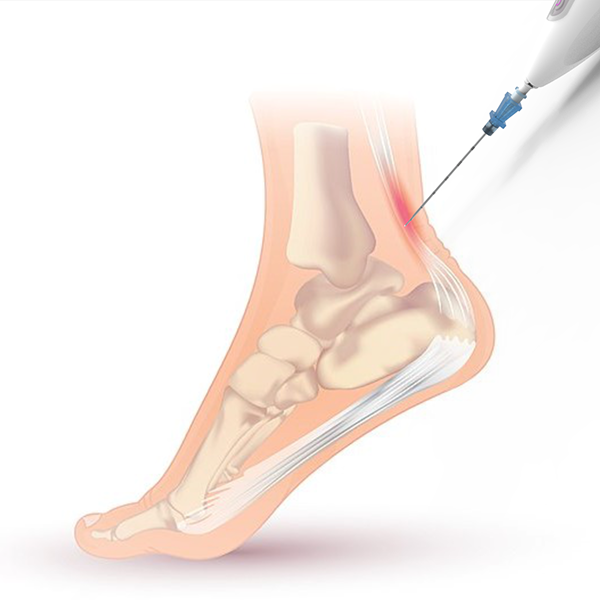 FDA Clears the Way for Surgical Device Developed in Coulter Department ...